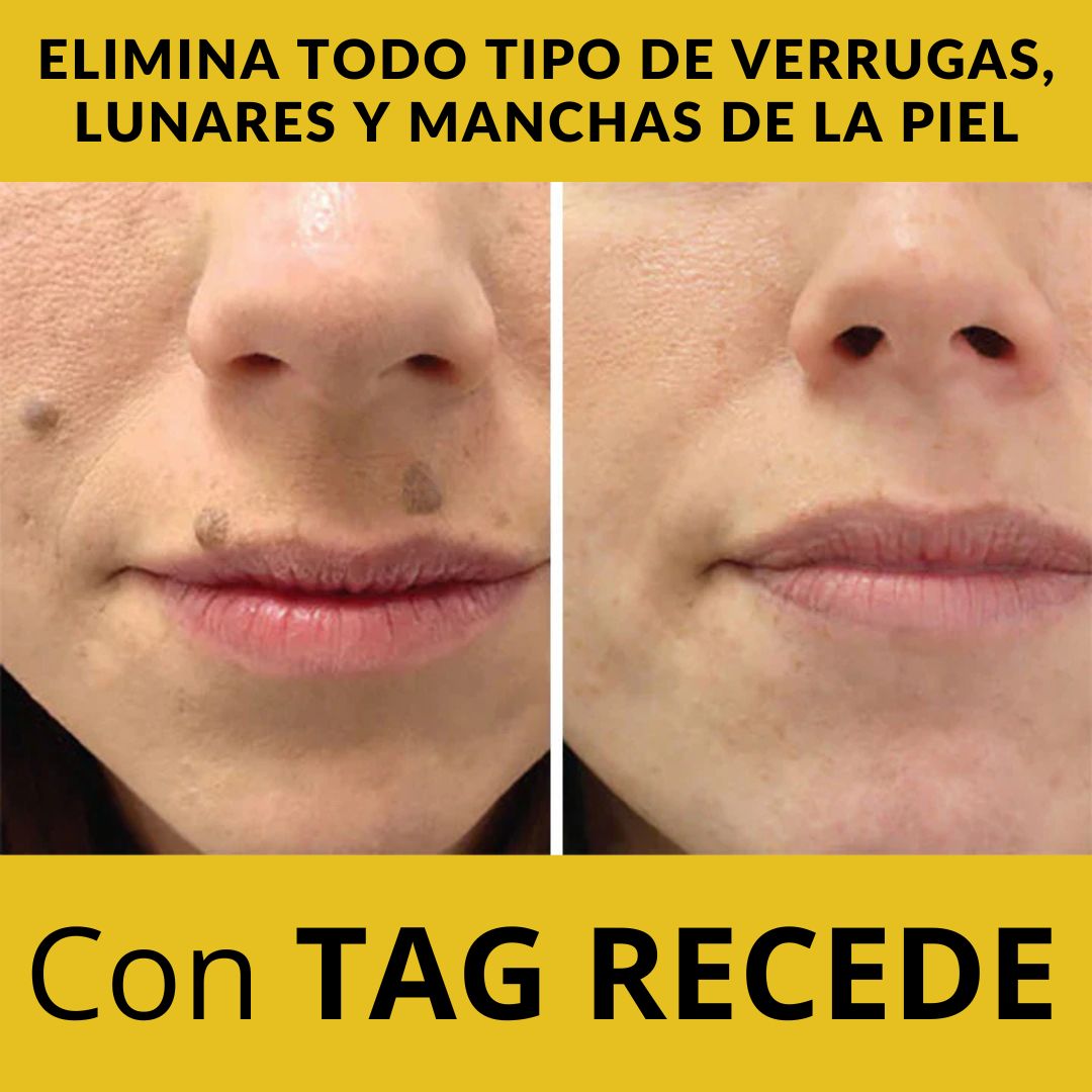 TAG RECEDE - Eliminador de Verrugas y Manchas – COMPRAMELOYA.COM